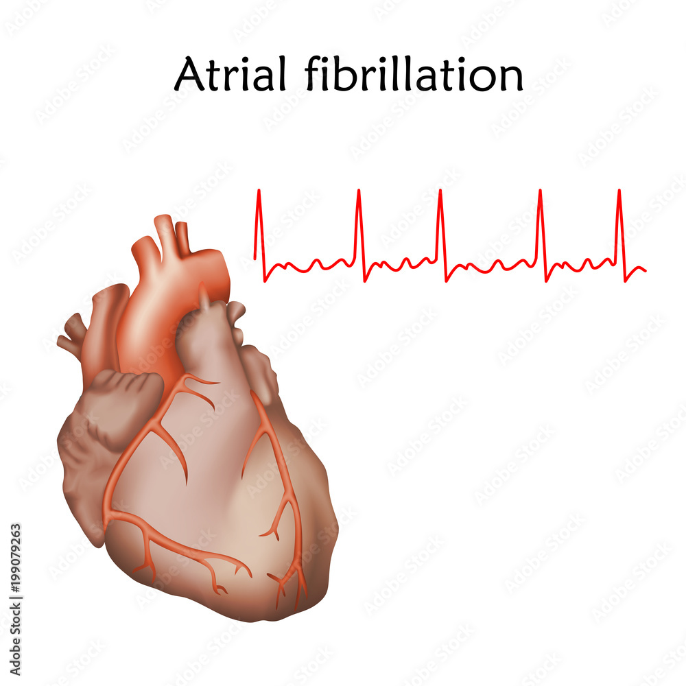Human heart. Atrial fibrillation. Anatomy illustration. Red image ...