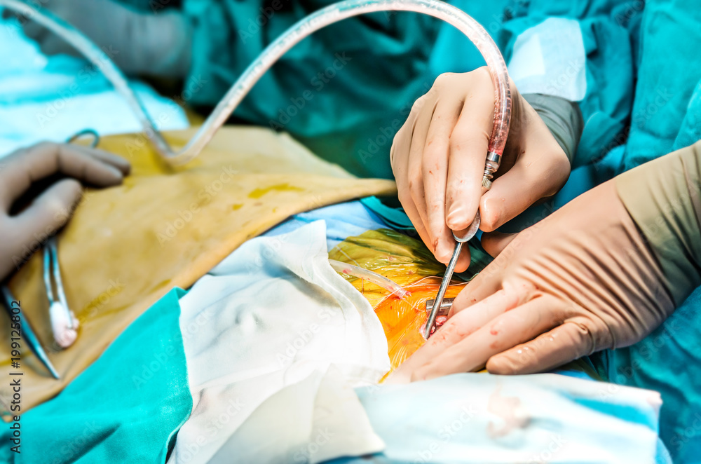 Poster The surgeon removes excess fluid after a wound is shed with the ...