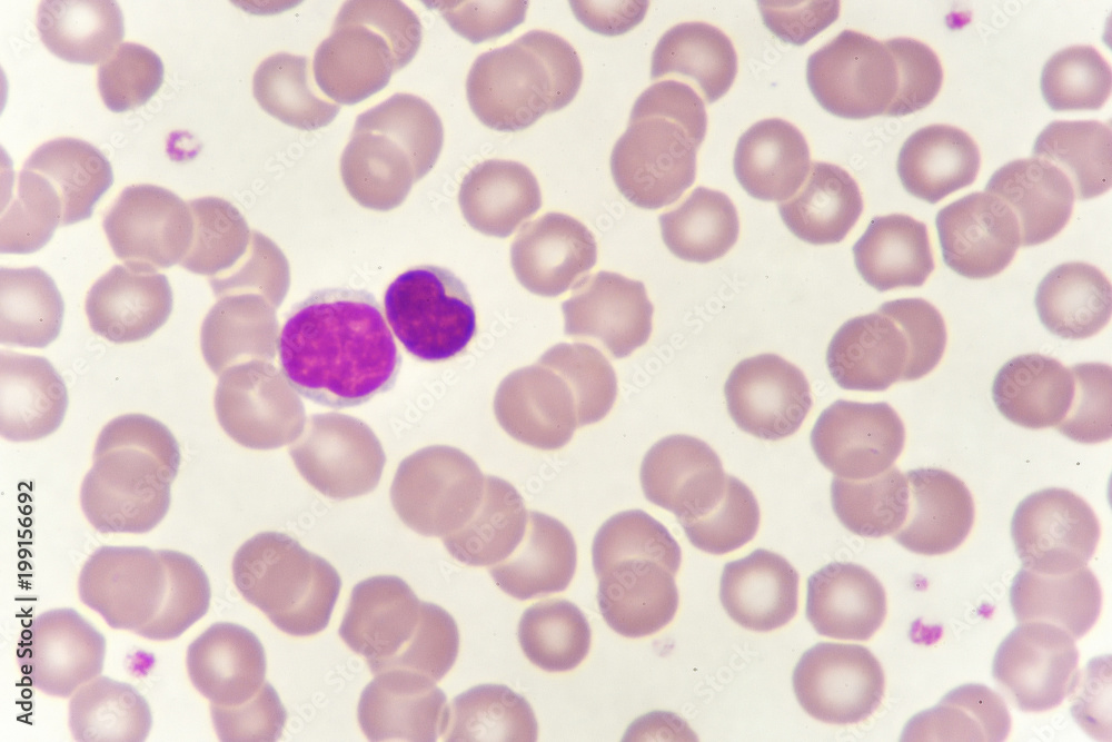 Lymphocyte cells (white blood cell) in blood smear, analyze by ...
