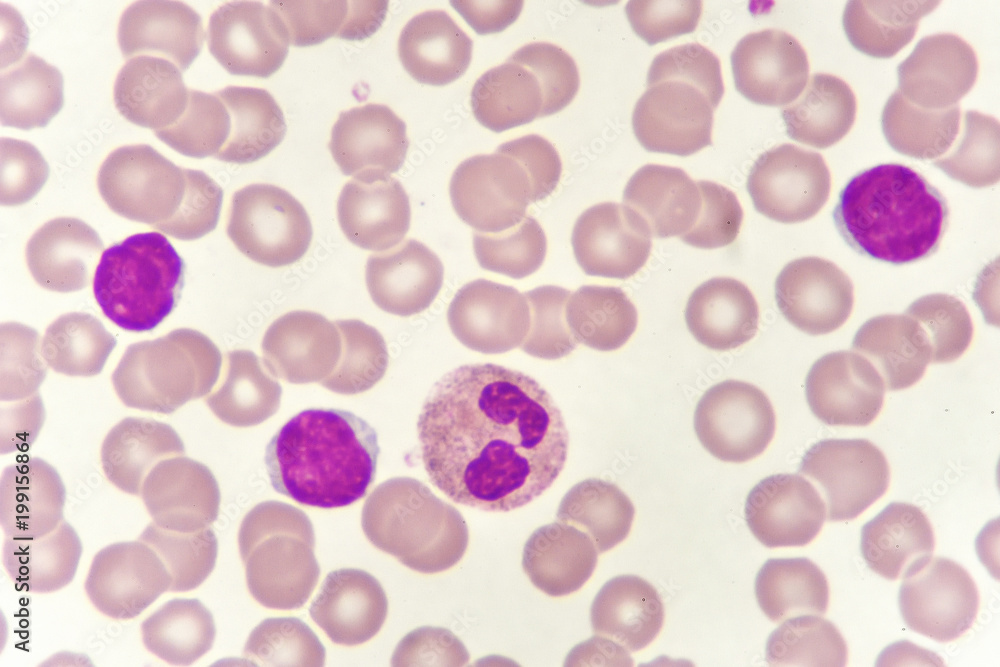 Blood smear of chronic lymphocytic leukemia (CLL), analyze by ...