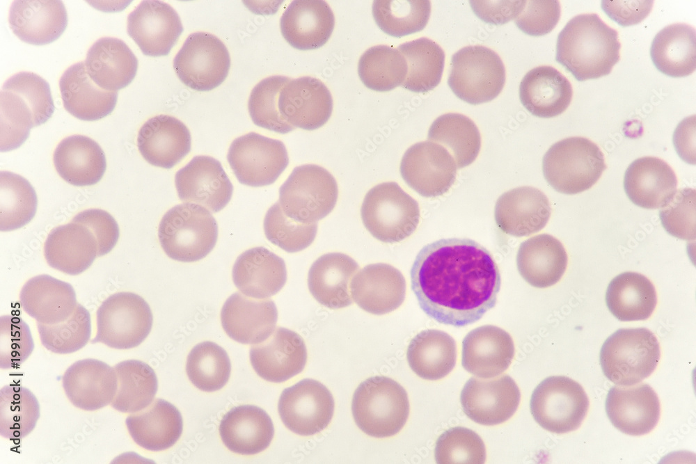 Lymphocyte cell (white blood cell) in blood smear, analyze by ...