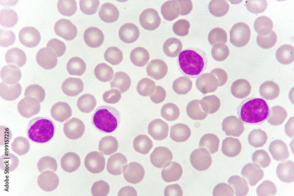 Blood smear of chronic lymphocytic leukemia (CLL), analyze by ...