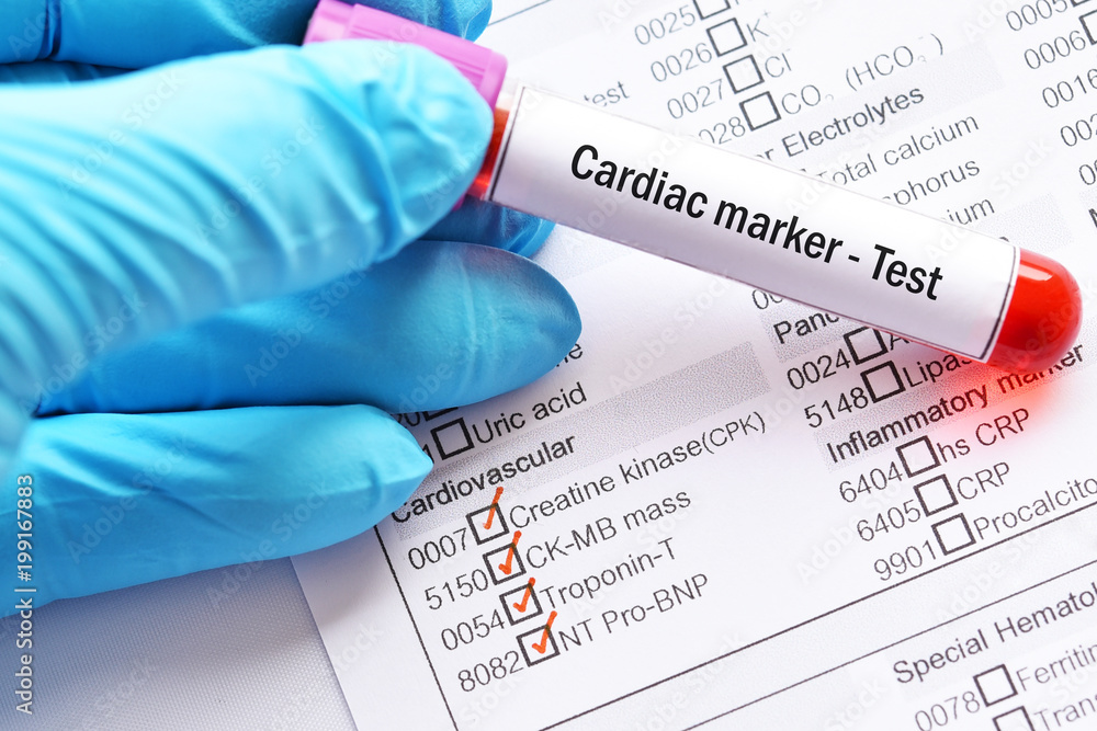 Blood sample for cardiac marker test Stock Photo | Adobe Stock