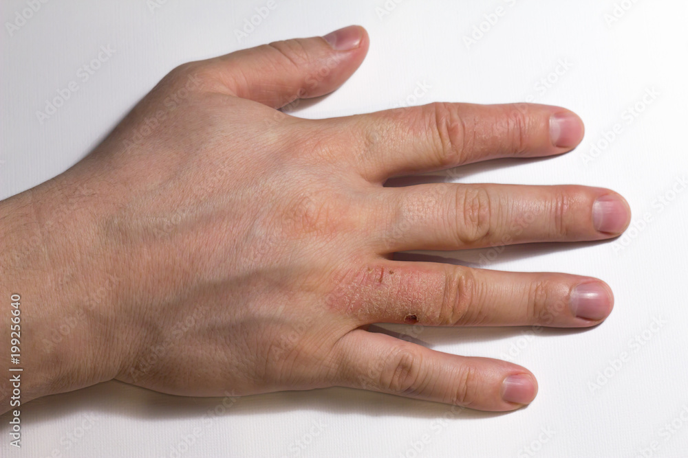 Hand dermatitis. Hand eczema Stock Photo | Adobe Stock