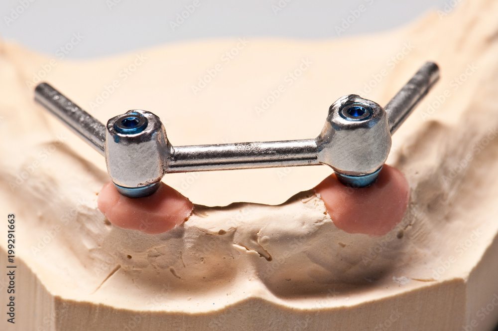 Dental implant made by titan on skeletal mandible support. Stock Photo ...