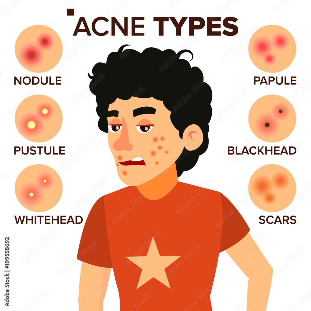 Acne Types Vector. Boy With Acne. Pimples, Wrinkles, Dry Skin ...