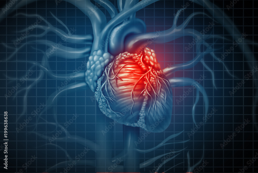 Heart Attack Stock Illustration | Adobe Stock