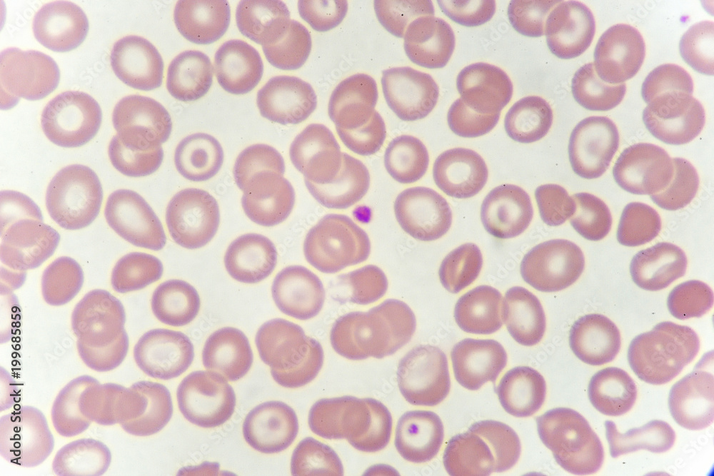 Target cells with abnormal red blood cells from anemia patient, analyze ...
