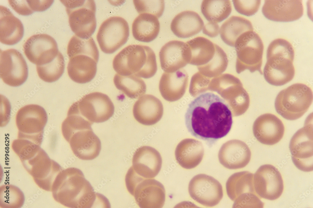 Lymphocyte cells (white blood cell) in blood smear, analyze by ...