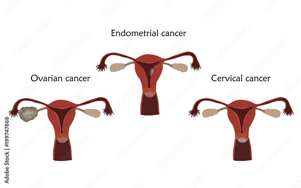 Ovarian, endometrial and cervical cancer. Human realistic uterus ...