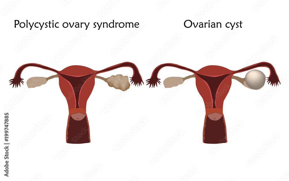 Polycystic ovary syndrome and ovarian cyst. Human realistic uterus ...