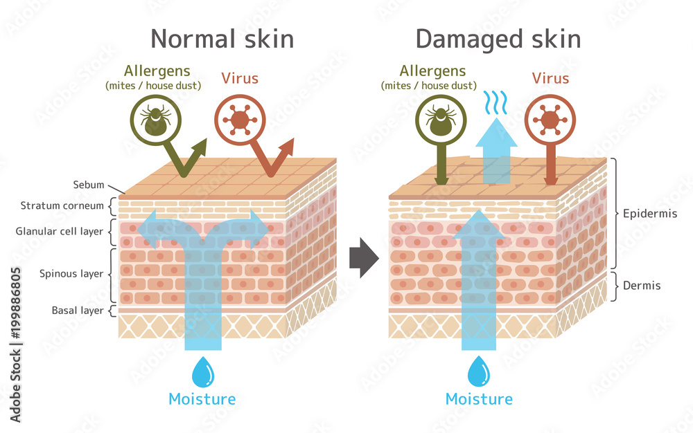 Sectional view of the skin.Comparison illustration of protection effect ...