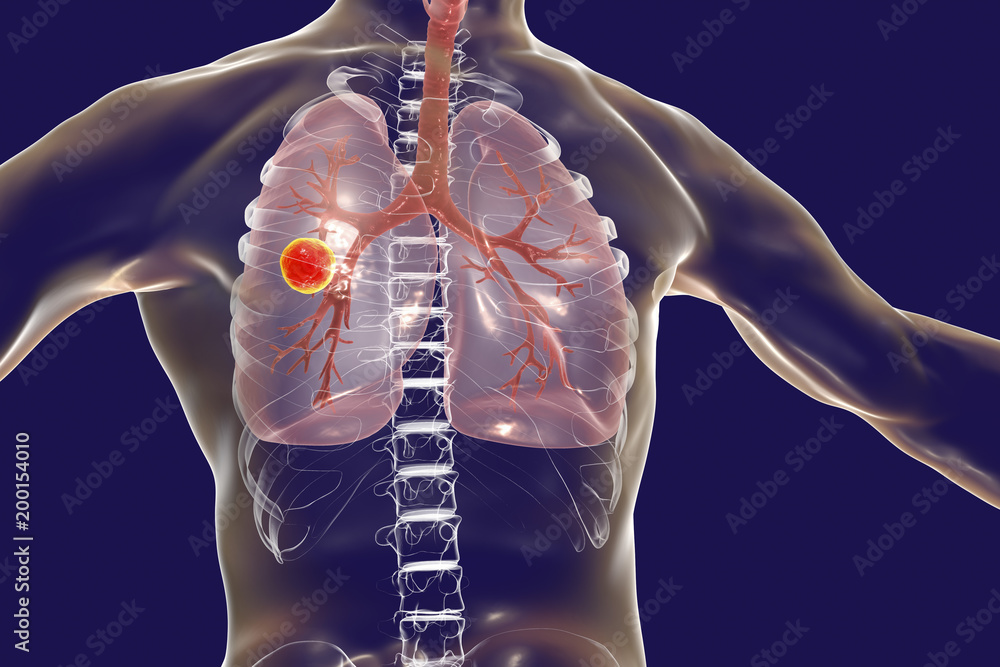 Fibrous-cavernous pulmonary tuberculosis, 3D illustration showing ...