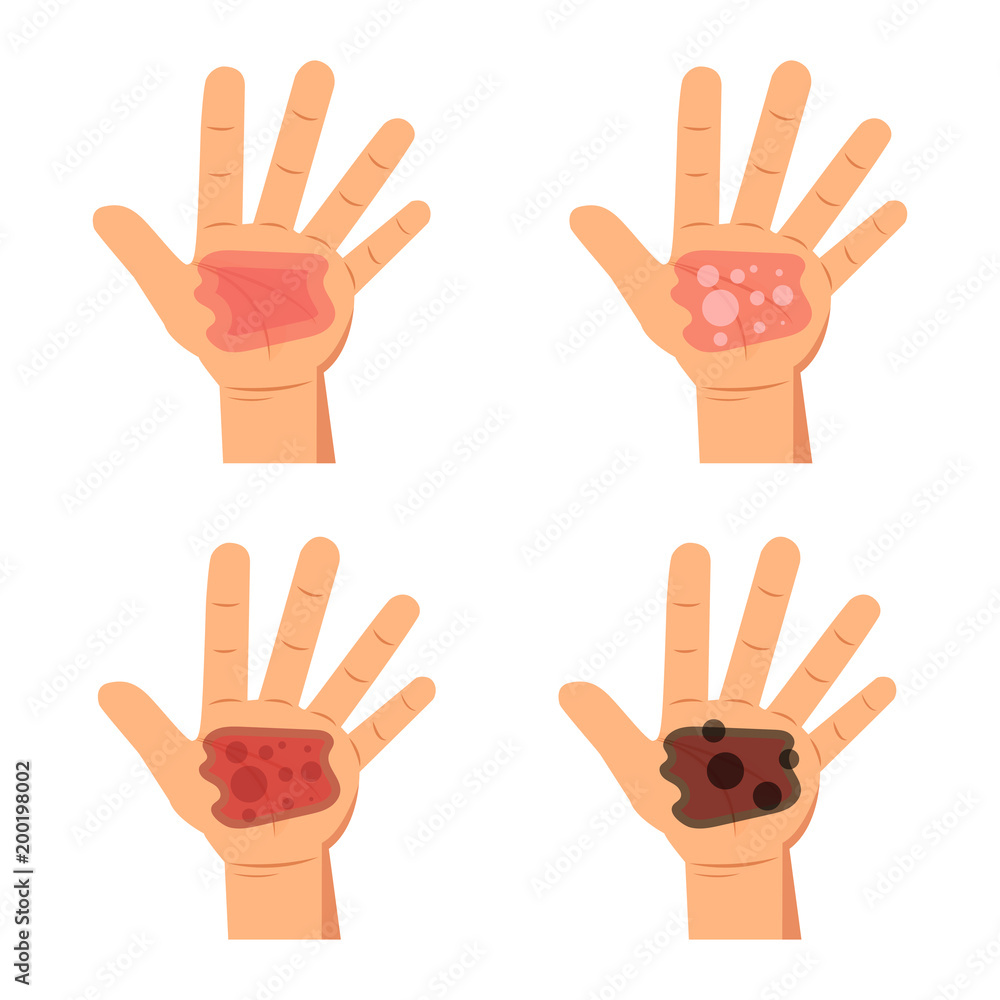 Degree burns of skin. Infographic Vector illustration. Stock Vector ...