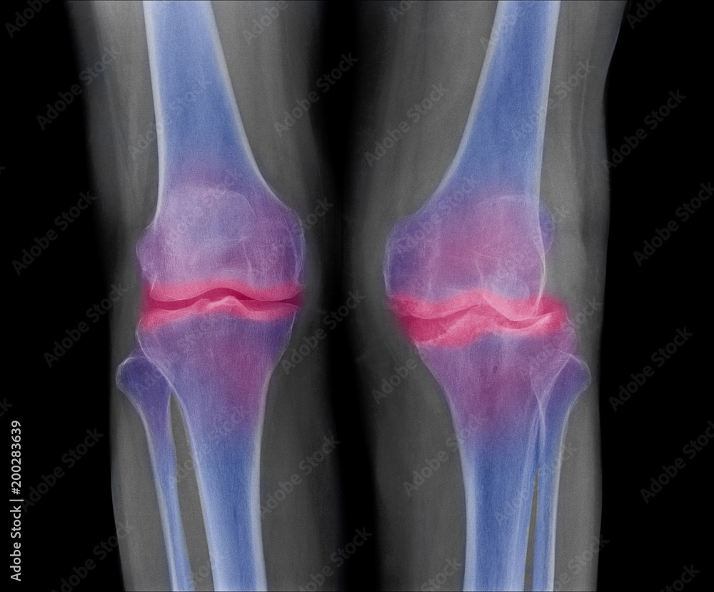 knee x-ray show Osteoarthritis(OA). Film on both side front view ...