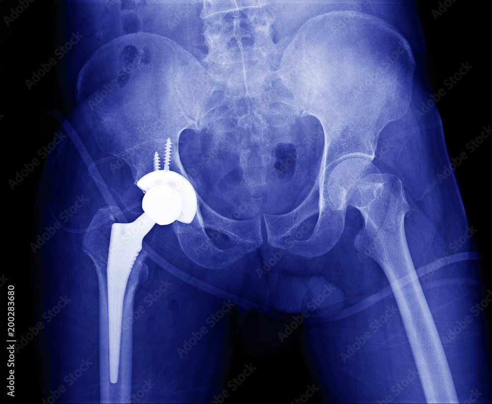 immediate postoperative x-ray image of both hip, anteroposterior view ...