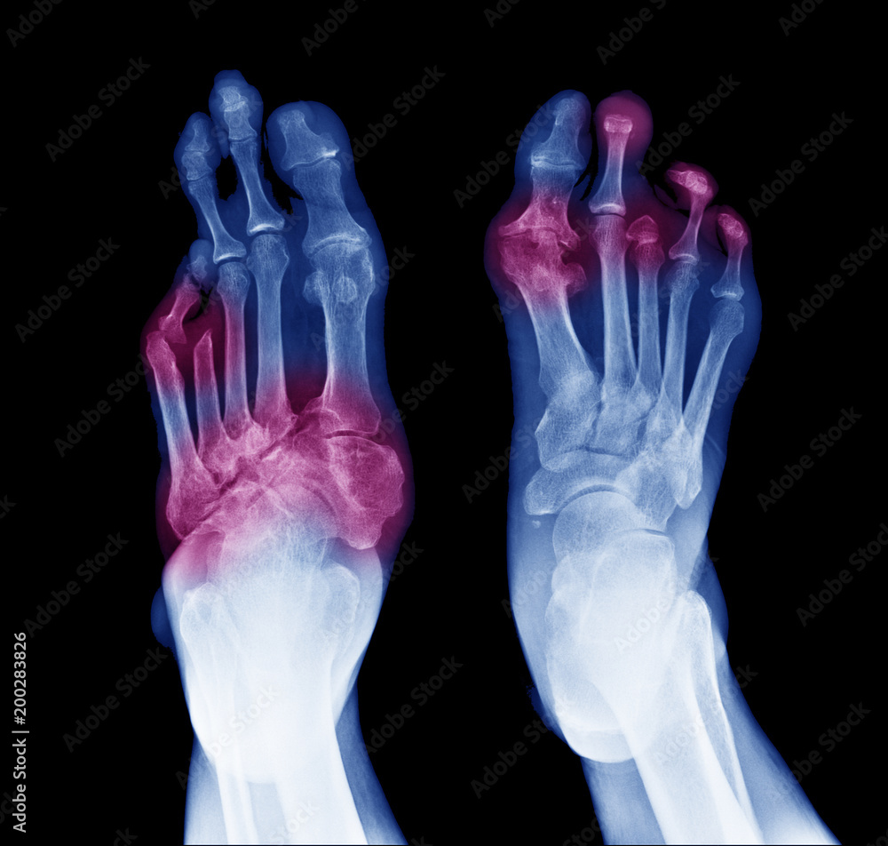 X-ray image of diabetic feet, posterior view show amputation toes and ...