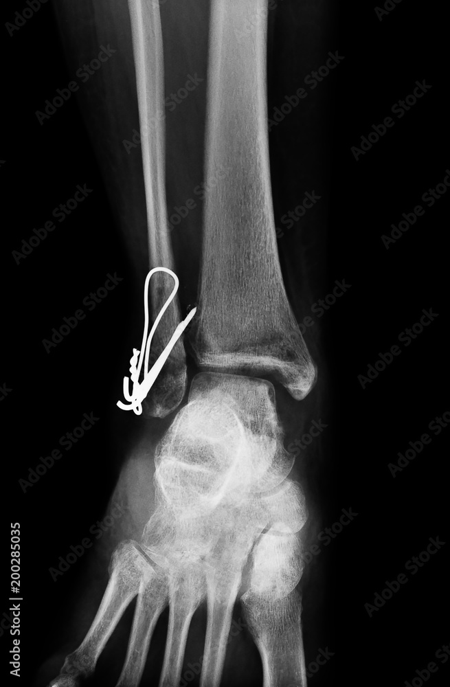 The Bend Of Leg And Foot X Ray