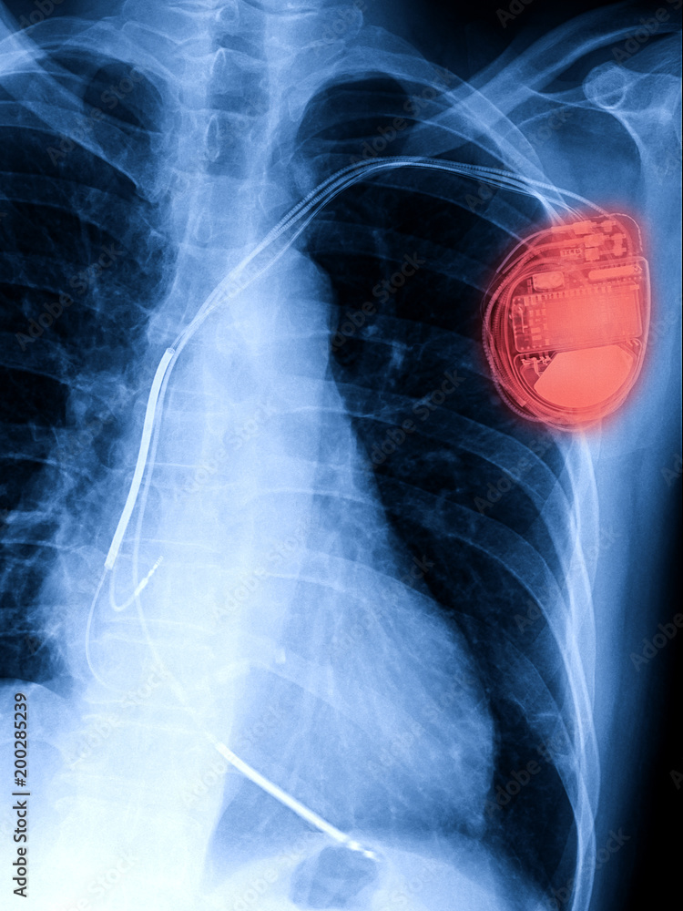 x-ray image of permanent pacemaker implant in chest body, device mark ...