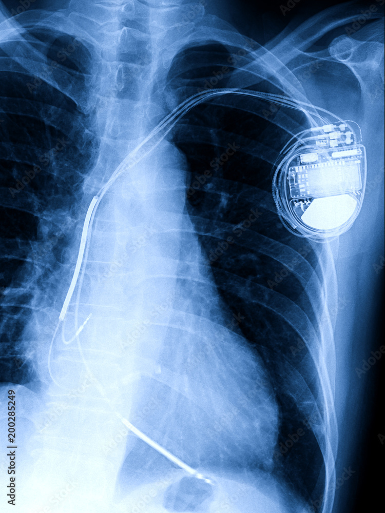 Stockfoto x-ray image of permanent pacemaker implant in chest body ...