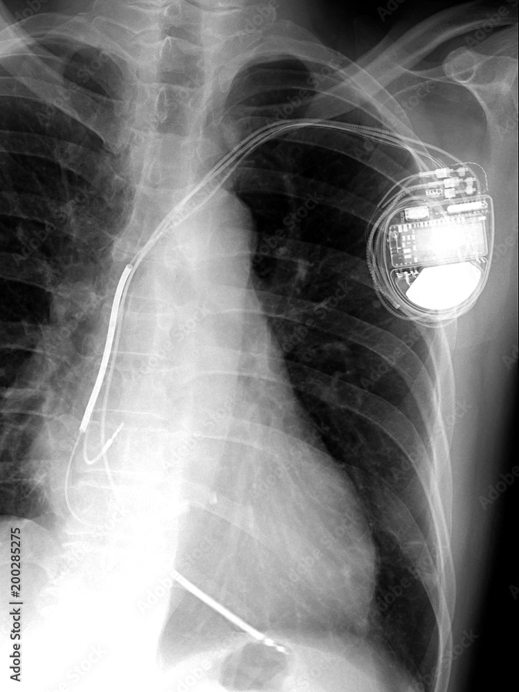 x-ray image of permanent pacemaker implant in chest body Stock Photo ...