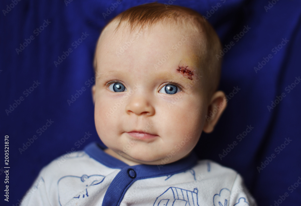 baby with scar on the face Stock Photo | Adobe Stock
