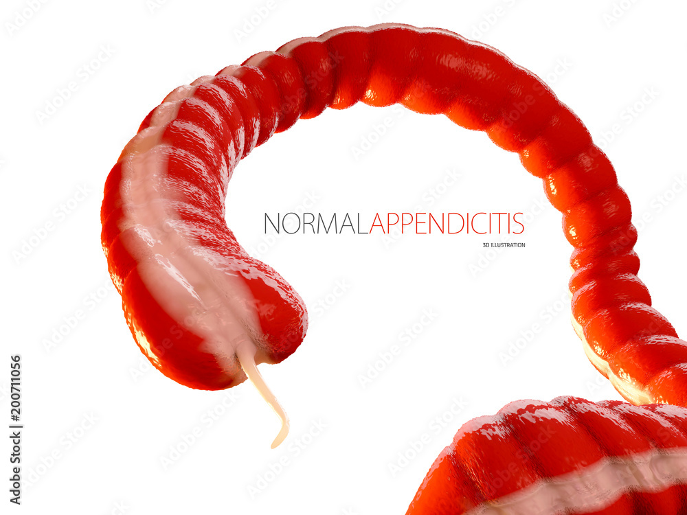 Appendicitis concept, human intestine anatomy as a 3D illustration ...