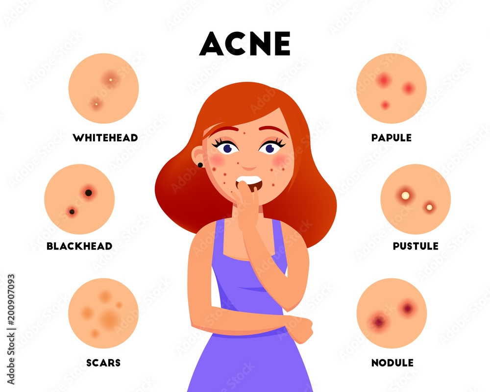 Acne types infographic elements vector flat illustration. Girl with ...
