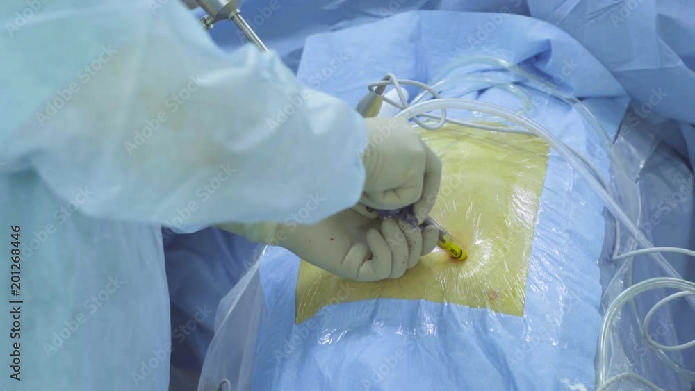 Close up hands of a surgeon inserting trocar (special medical device ...