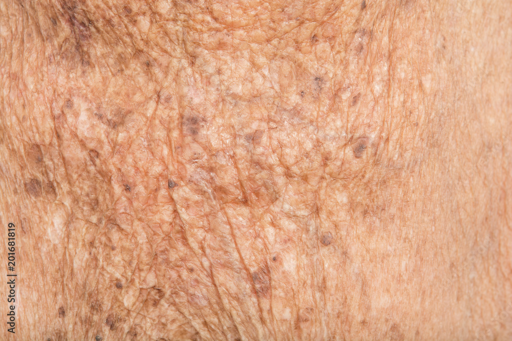 Skin of wrinkles in very old woman and Freckles on the face Stock Photo ...