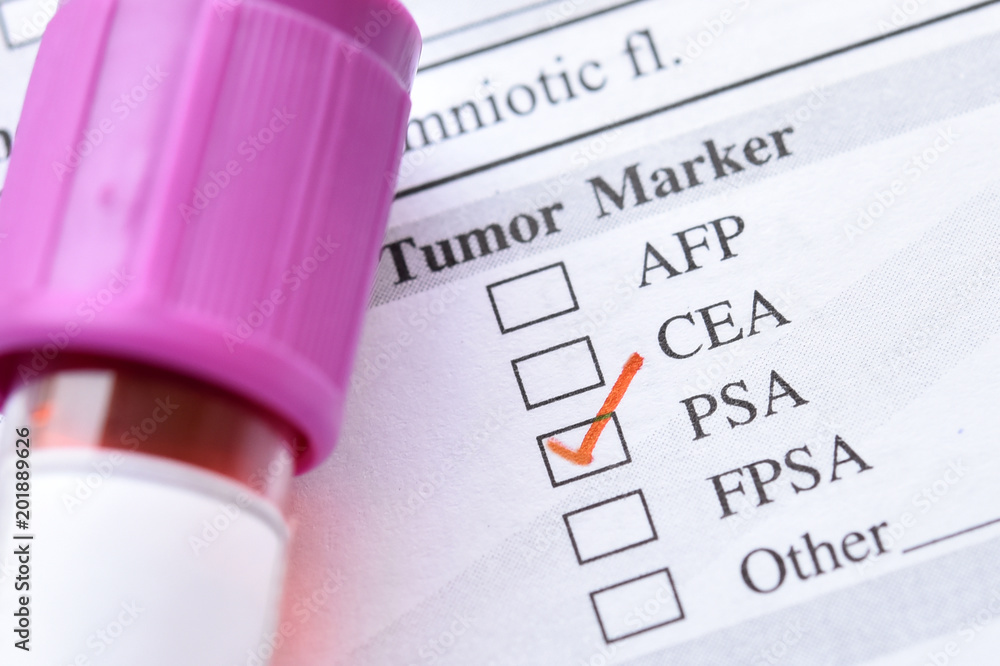 Blood sample for PSA (prostate specific antigen) test, diagnosis for ...
