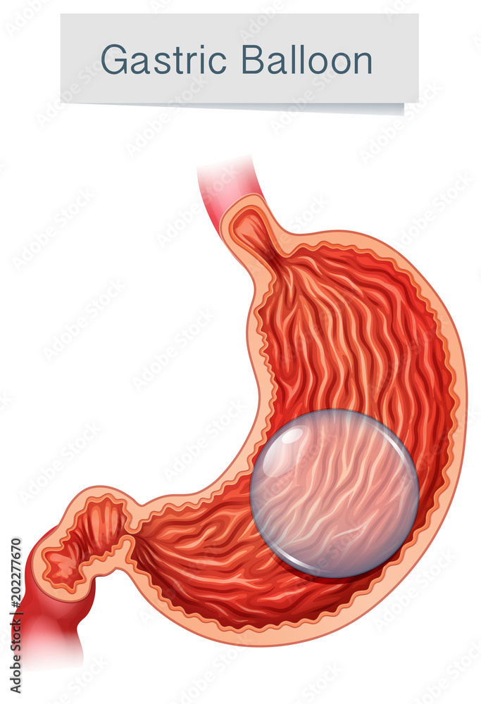 Anatomy Medical Vector Gastric Balloon Stock Vector | Adobe Stock