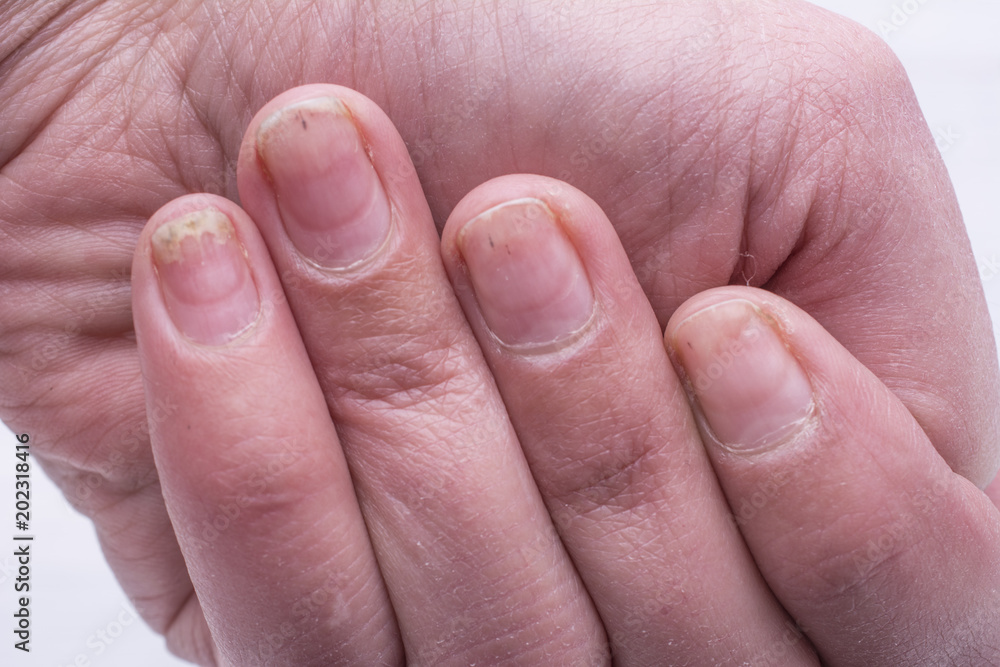 Onycholysis isolated on white background. Mechanical damage to the nail ...