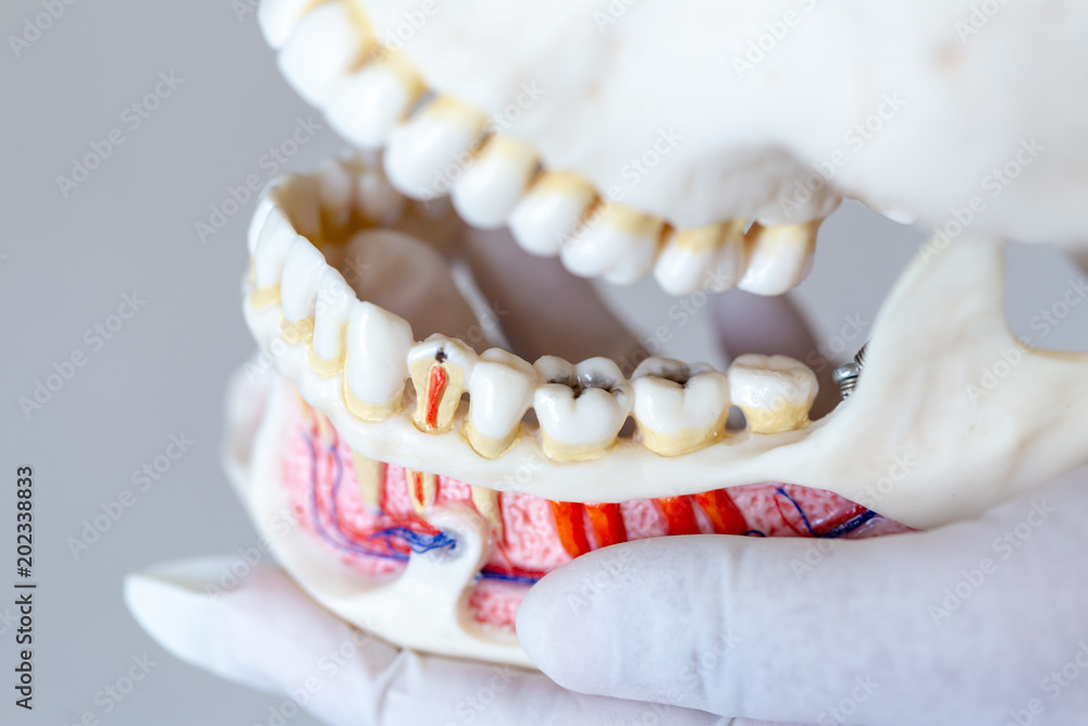 Study cast of Diagnostic cast and dental gypsum models in dental ...