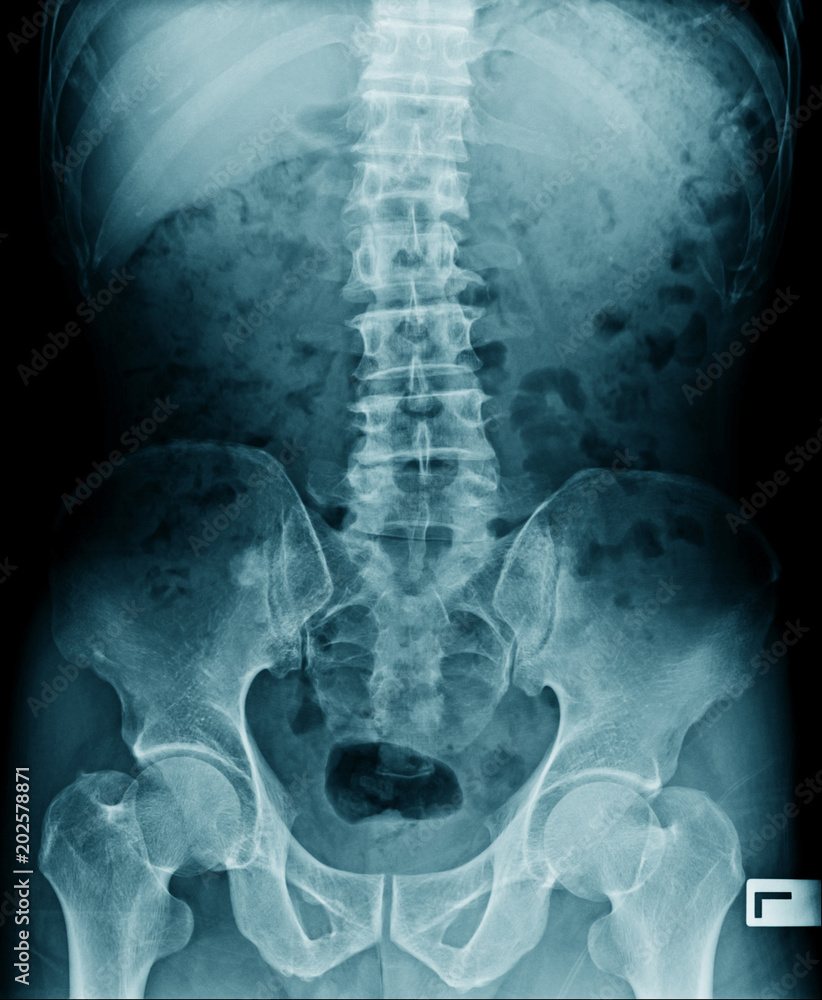 Lumbar Vertebrae X Ray
