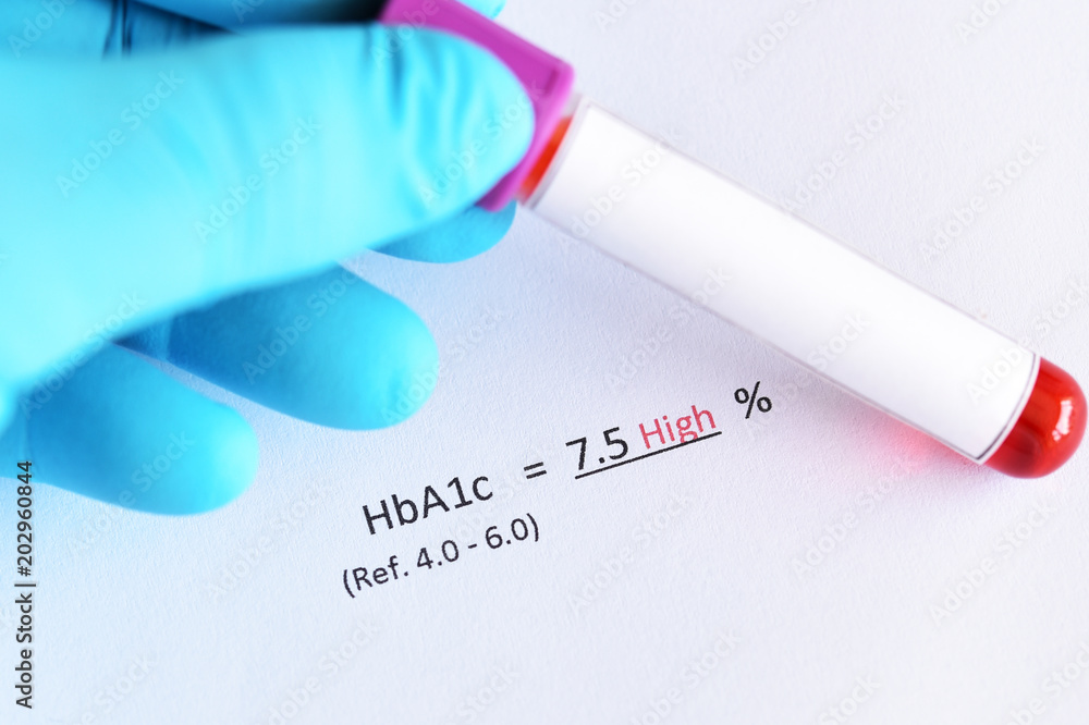 Blood sample with abnormal high HbA1c test result Stock Photo | Adobe Stock