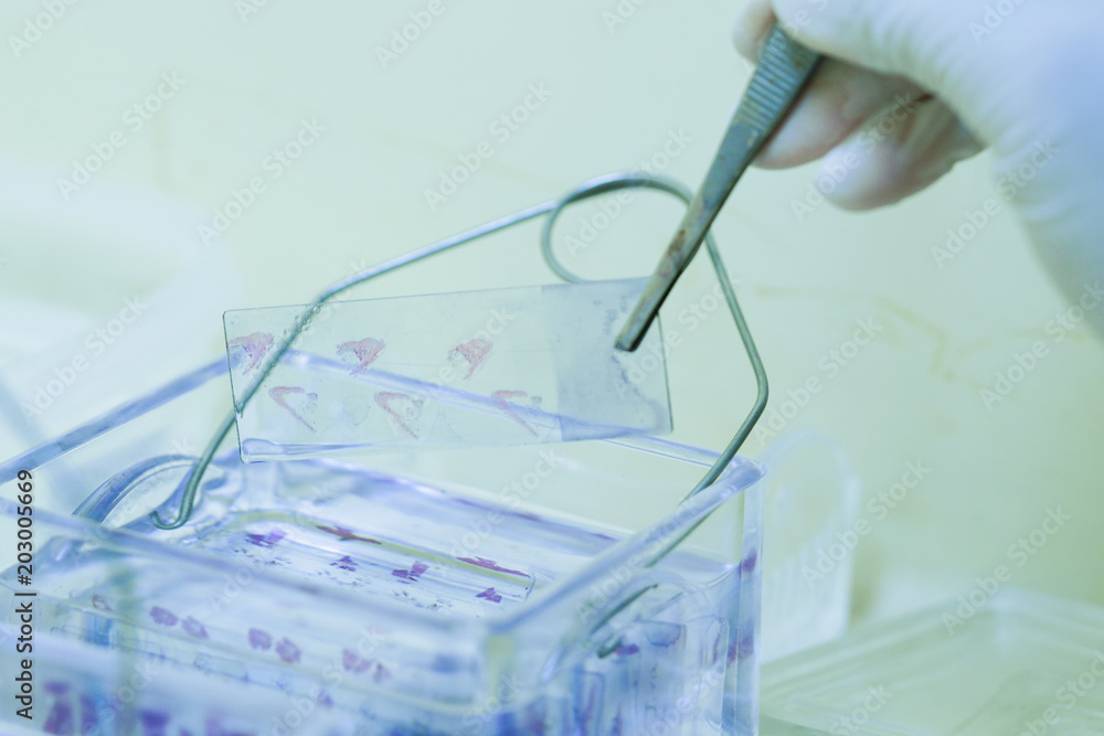 Microscope slide staining tissue biopsy for diagnosis in pathology ...