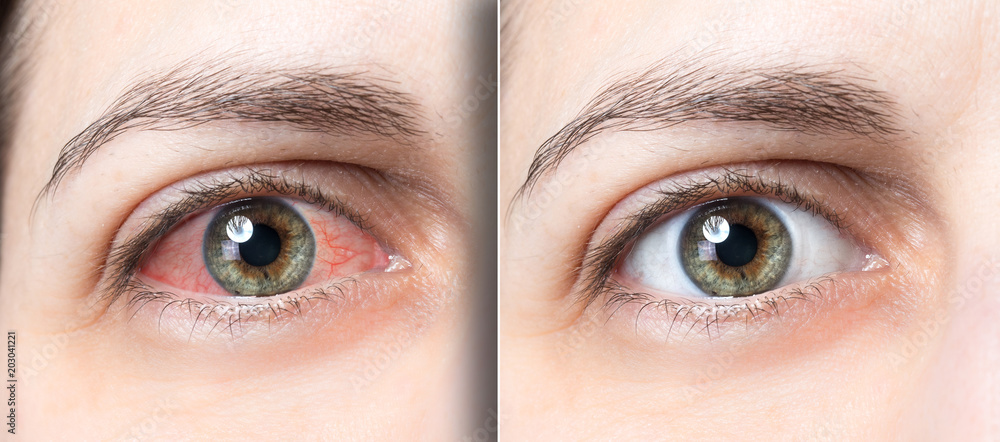 Woman red eye before and after eyewas Stock Photo | Adobe Stock