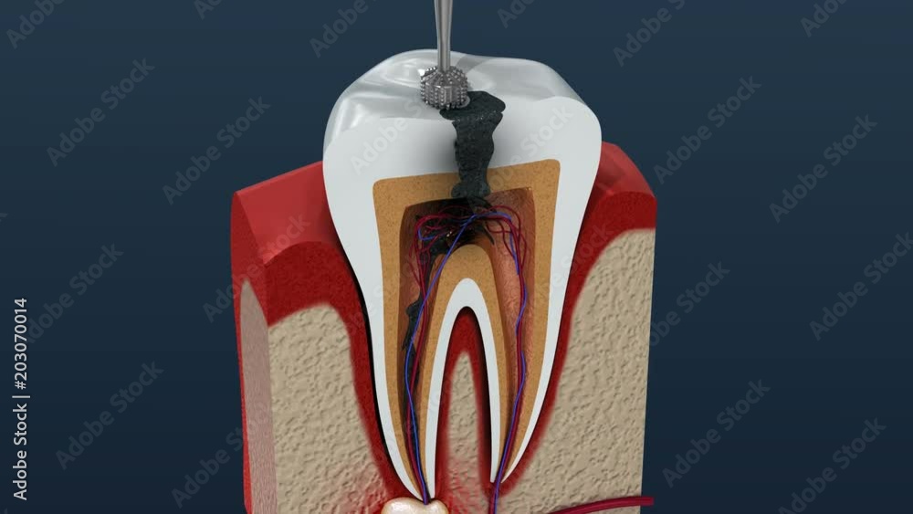 Root canal treatment process. 3D Animation. Stock Video | Adobe Stock