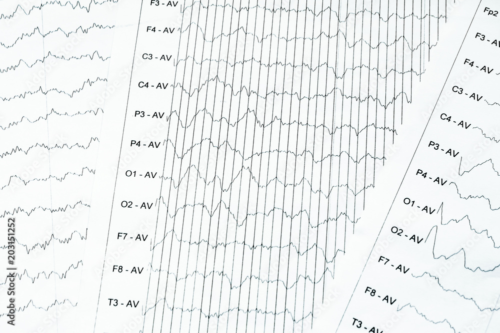 EEG electrophysiological monitoring method. EEG wave in human brain ...