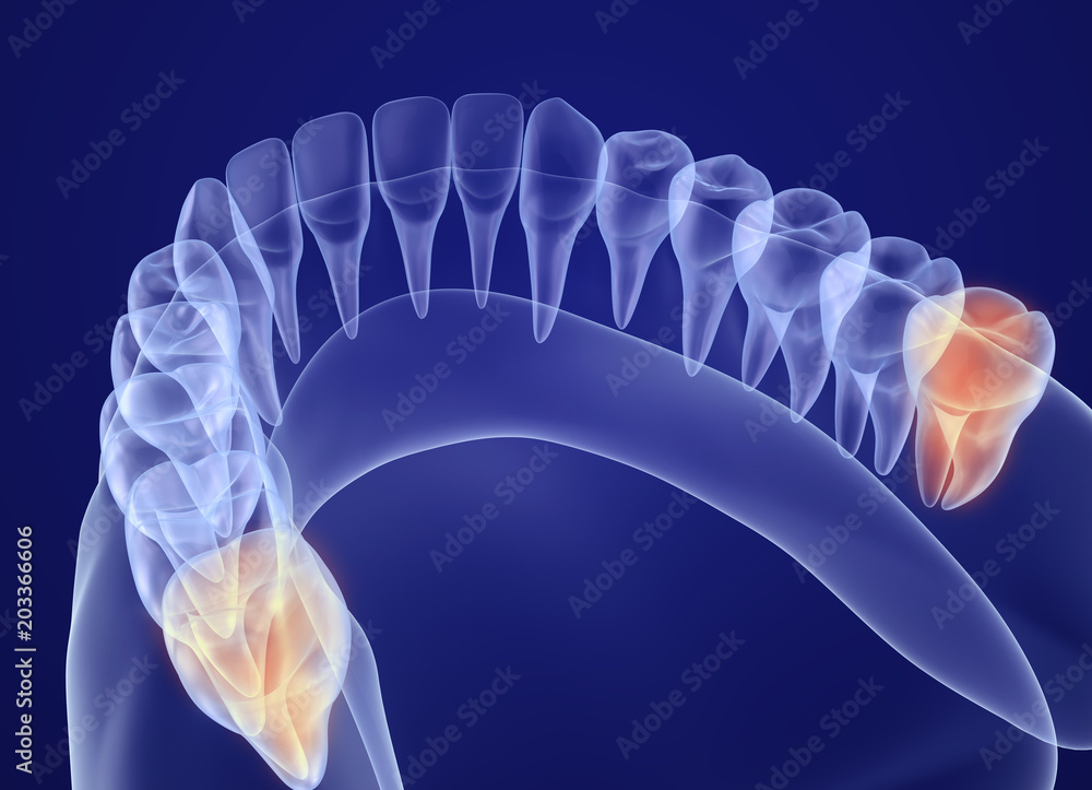 Wisdom tooth xray view. Medically accurate tooth 3D illustration Stock ...