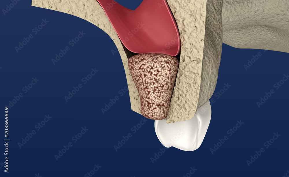 Foto de Sinus Lift Surgery - Sinus Augmentation. 3D illustration do ...