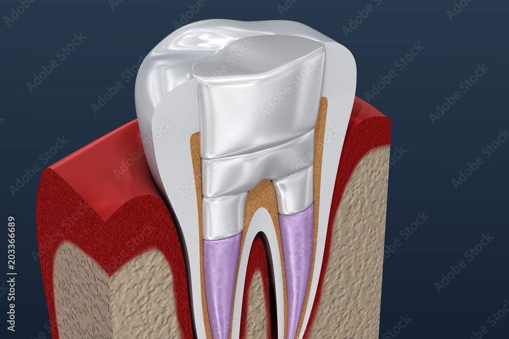 Dental fillings procedure diagramm . 3D illustration Stock Illustration ...