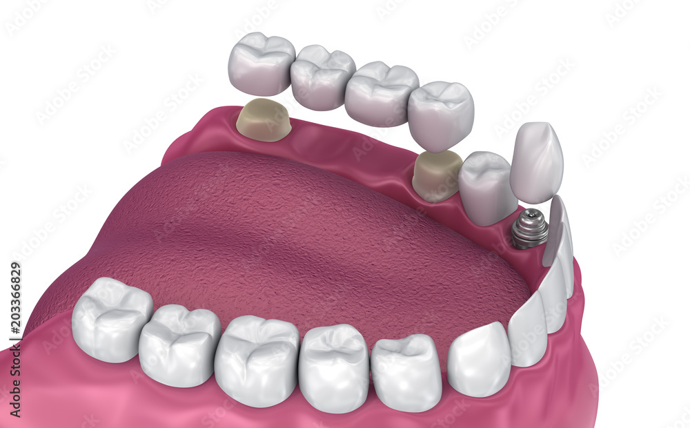 Tooth supported fixed bridge, implant and crown. Medically accurate 3D ...
