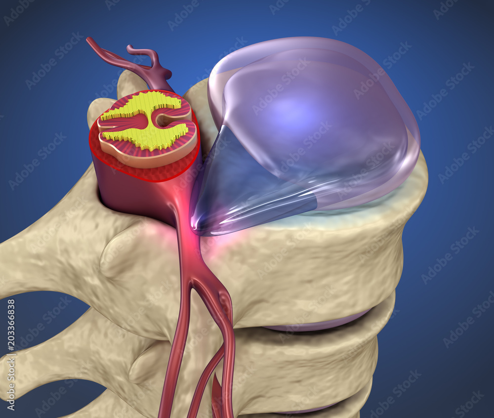 Spinal cord under pressure of bulging disc, 3d illustration Stock ...