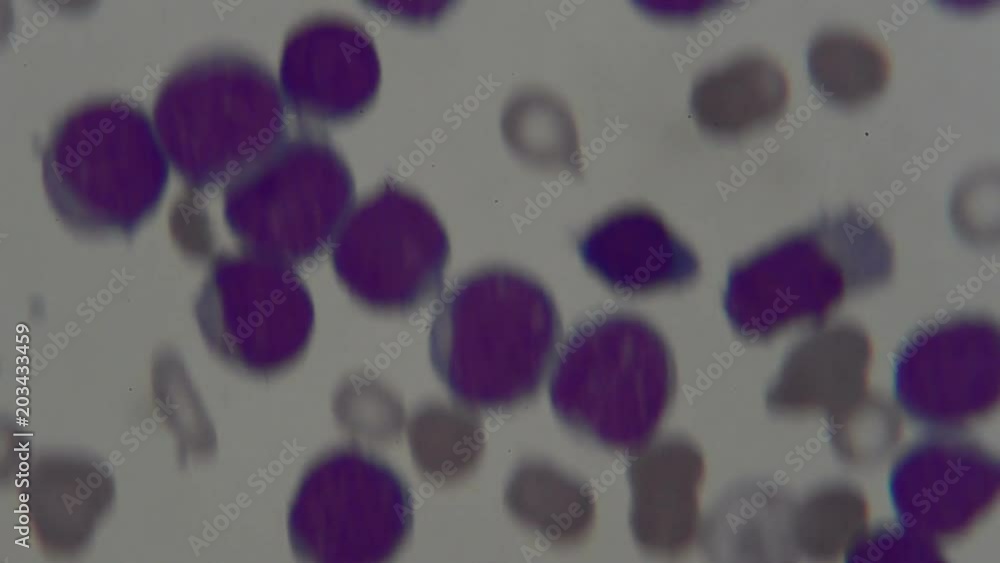 Stockvideo human blood smear under microscope , for analysis in ...