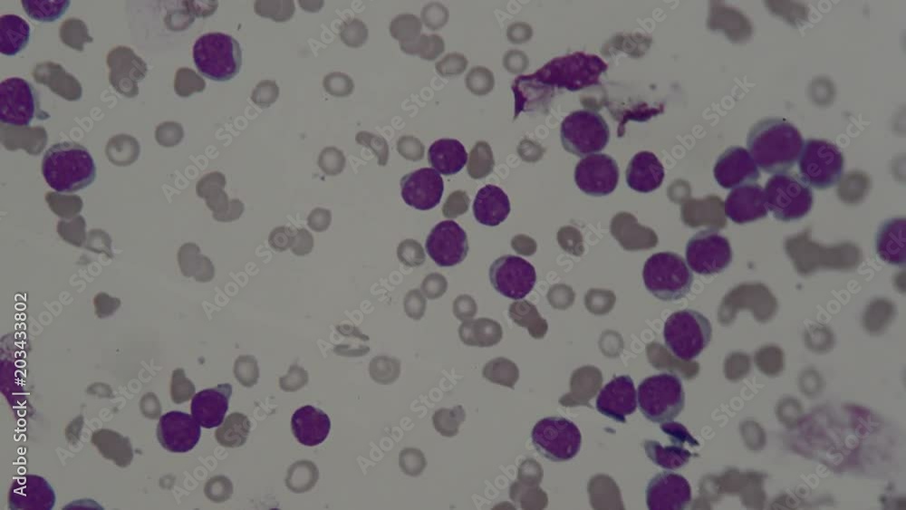 human blood smear under microscope , for analysis in laboratory Stock ...
