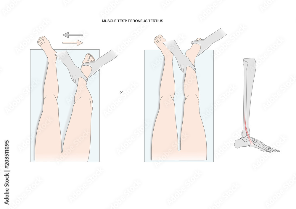 muscle testing: peroneus (tertius). Test used in kinesiology, neurology ...