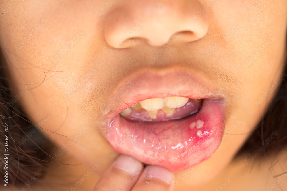 Foto de mouth ulcer or canker sore or aphthous stomatitis or aphthous ...