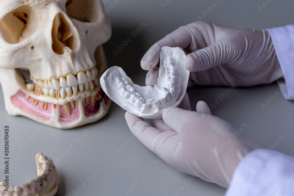 Study cast of Diagnostic cast and dental gypsum models in dental ...